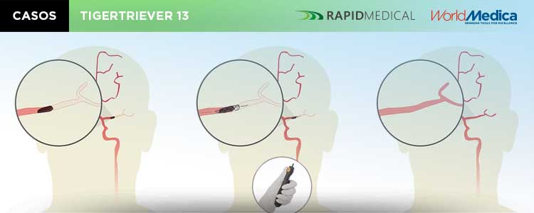 Case Report Tigertriever 13 - Case performed with our thrombus ...